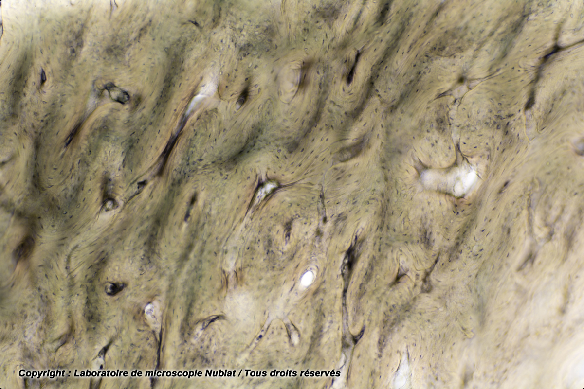 Os compact, sec (aminci par usure), CT, CN