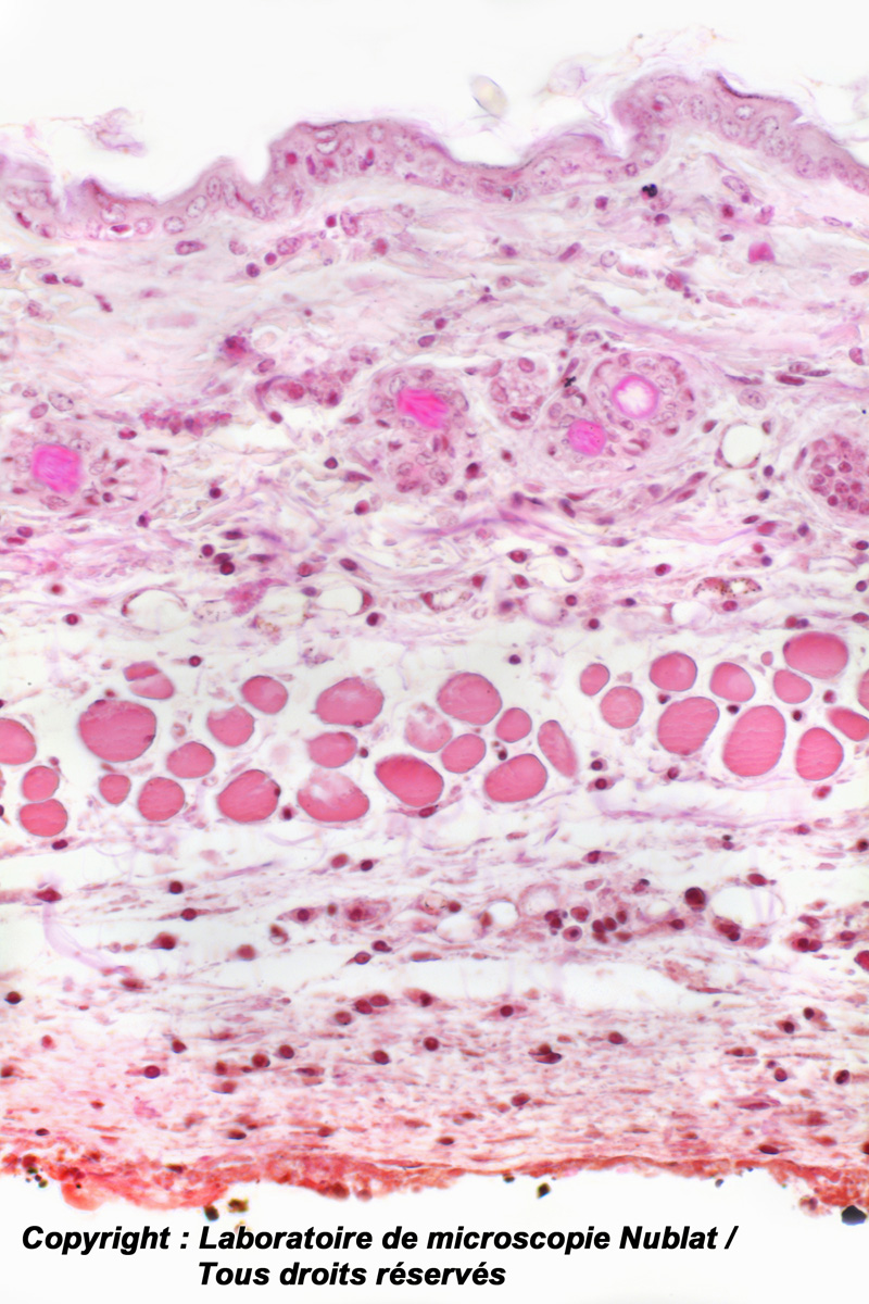 Rejet greffe de peau, HE