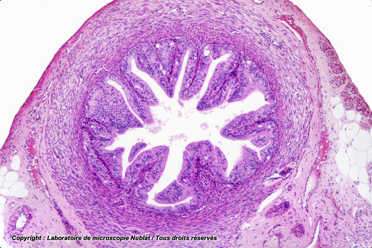 Trompe de Fallope, CT, HE