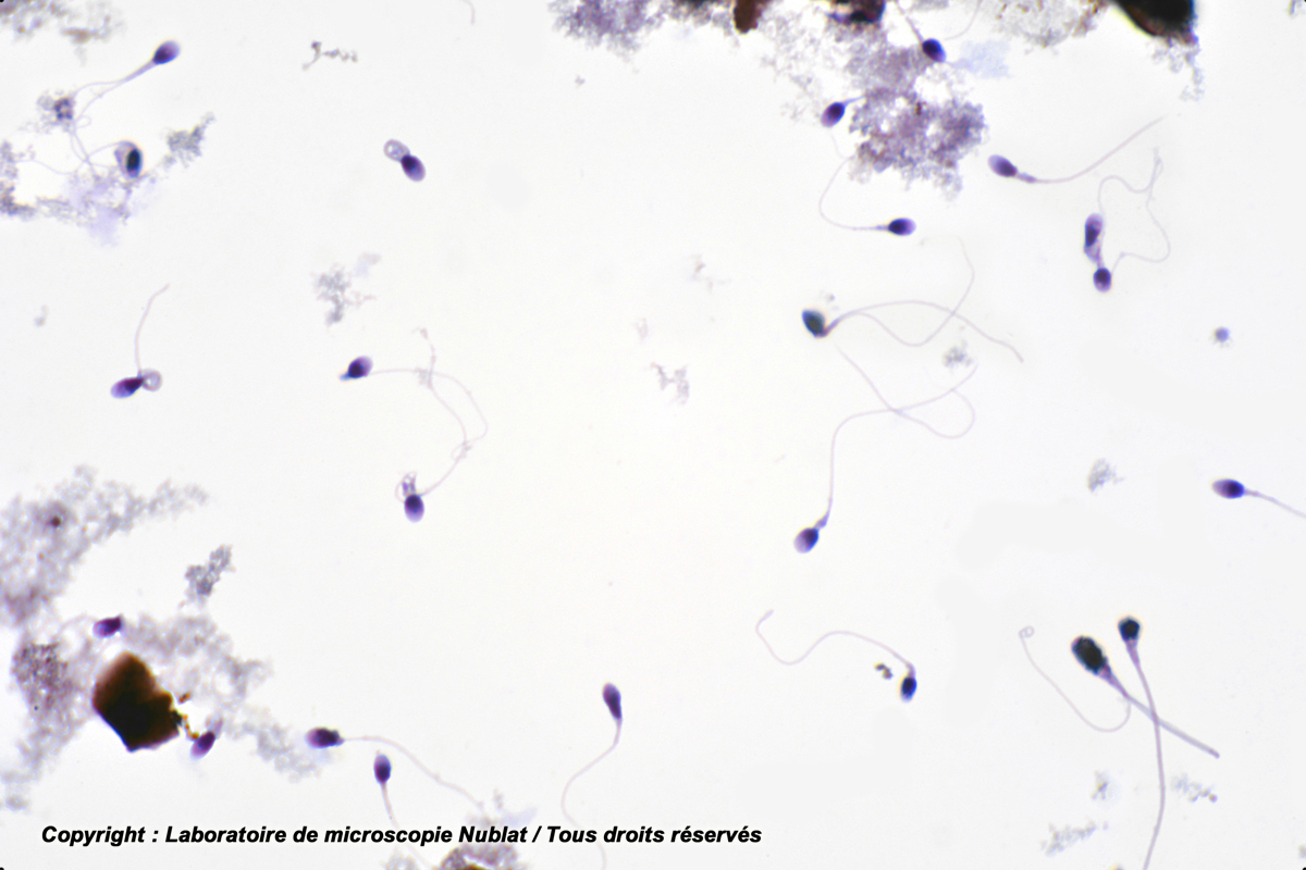 Spermatozoïdes pathologiques, homme, H